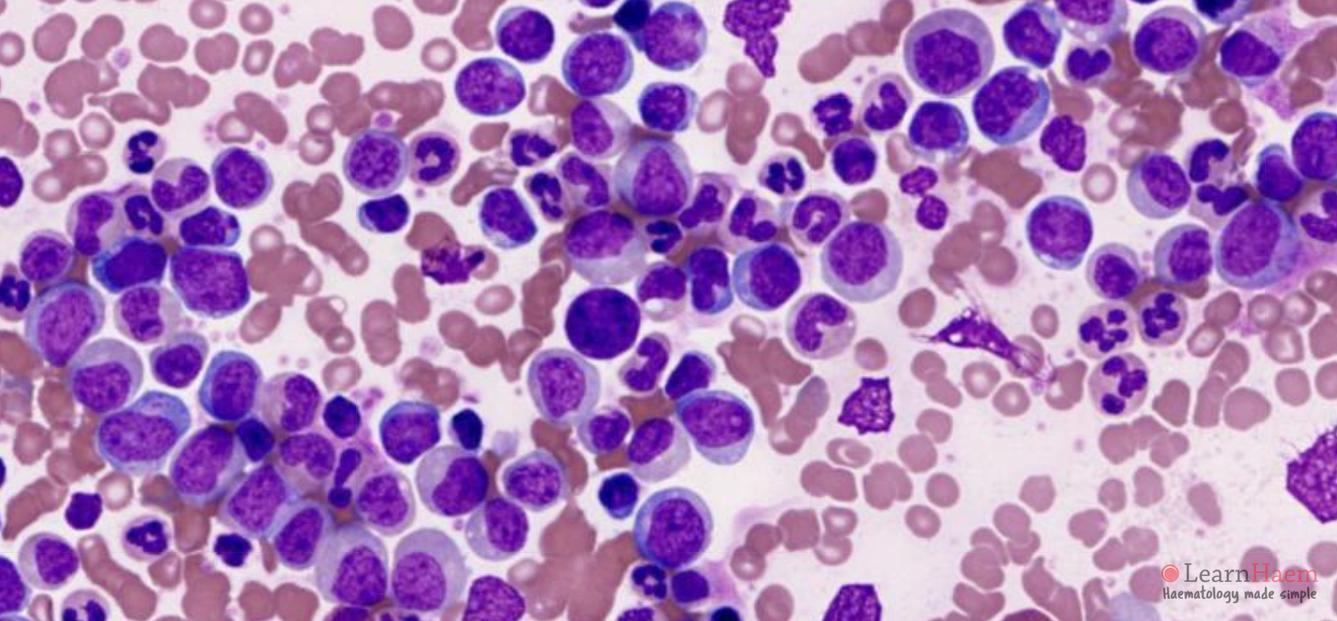 CML In Blast Phase LearnHaem Haematology Made Simple