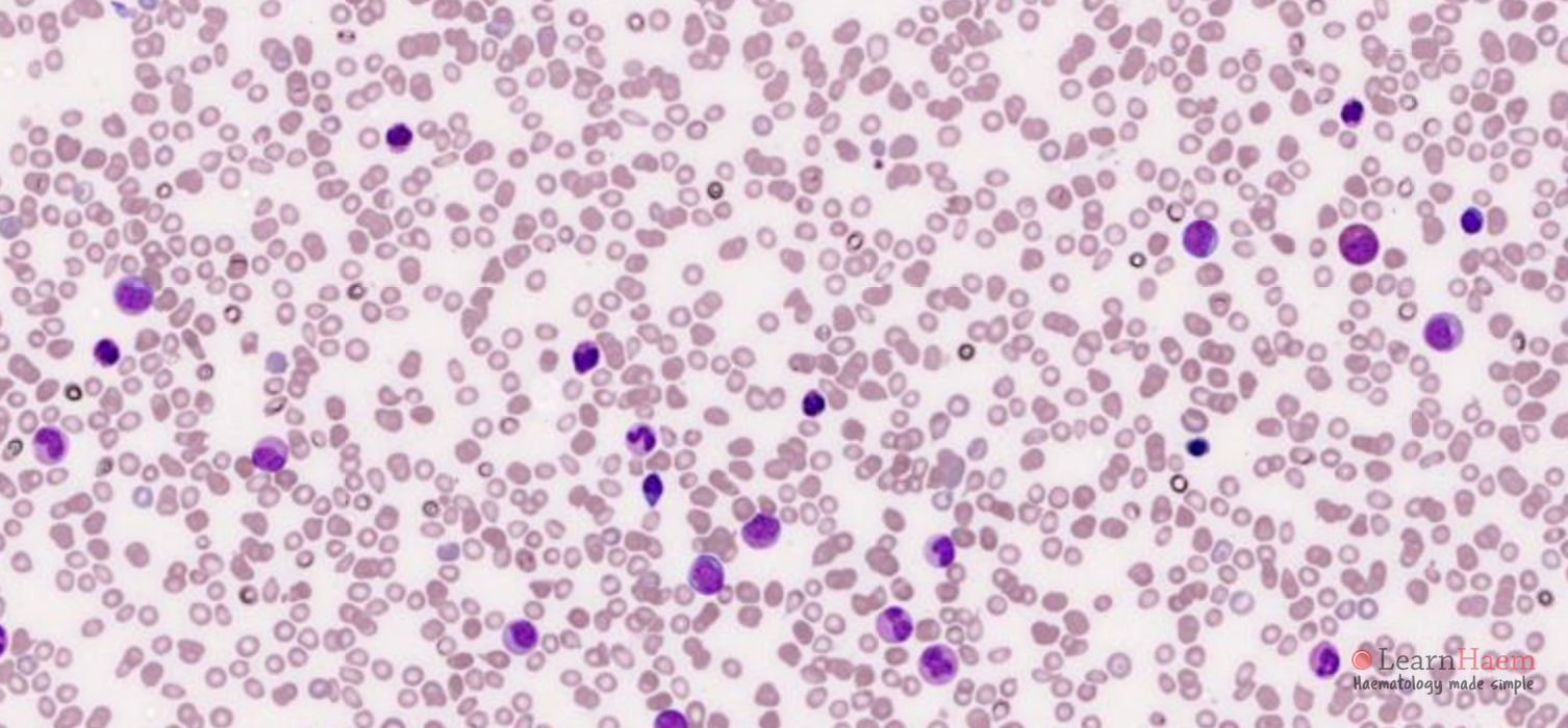 CML in Accelerated Phase | LearnHaem | Haematology Made Simple